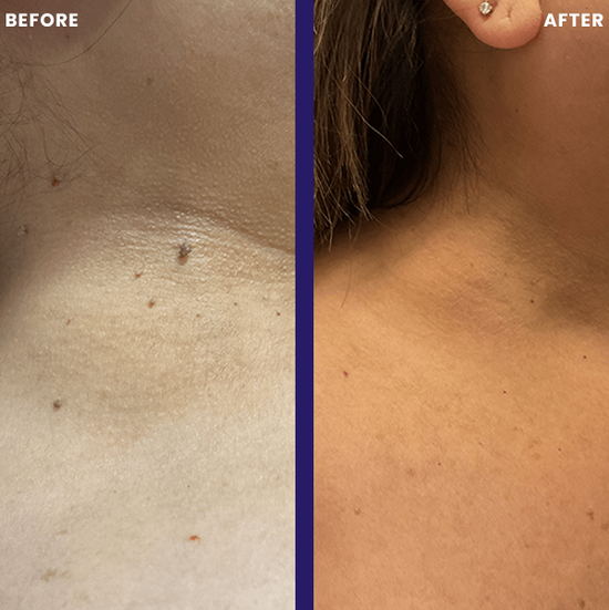 TagPal - Skin Tag Removal Kit