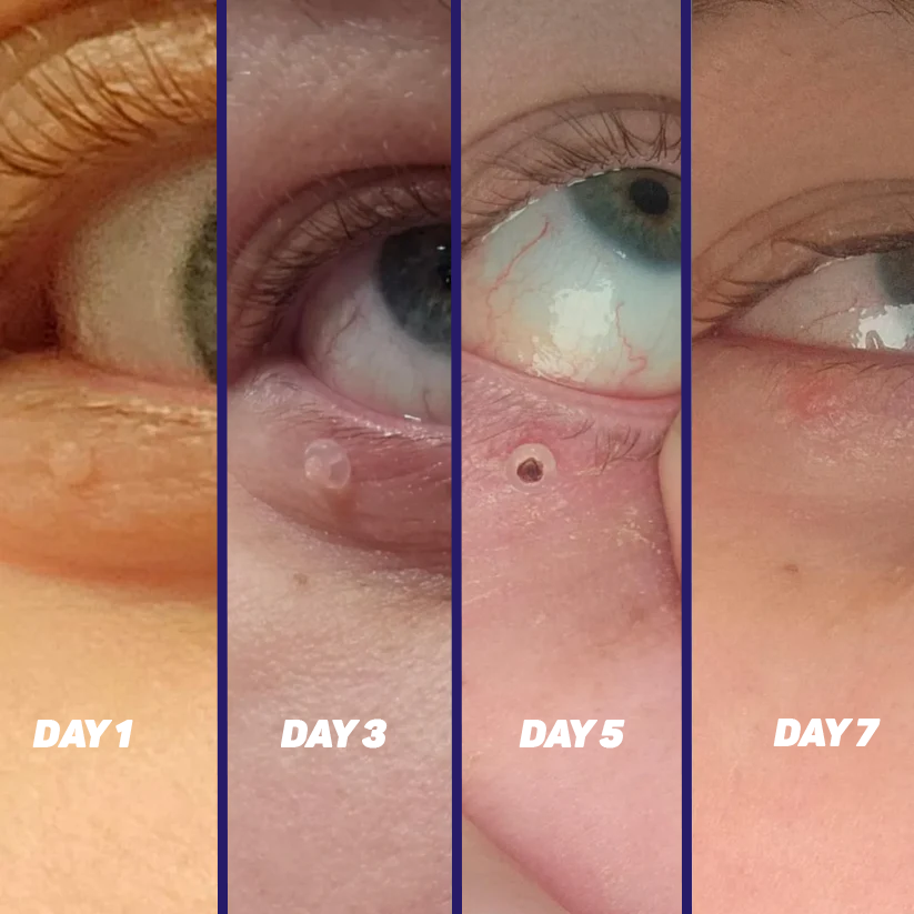 TagPal - Skin Tag Removal Kit